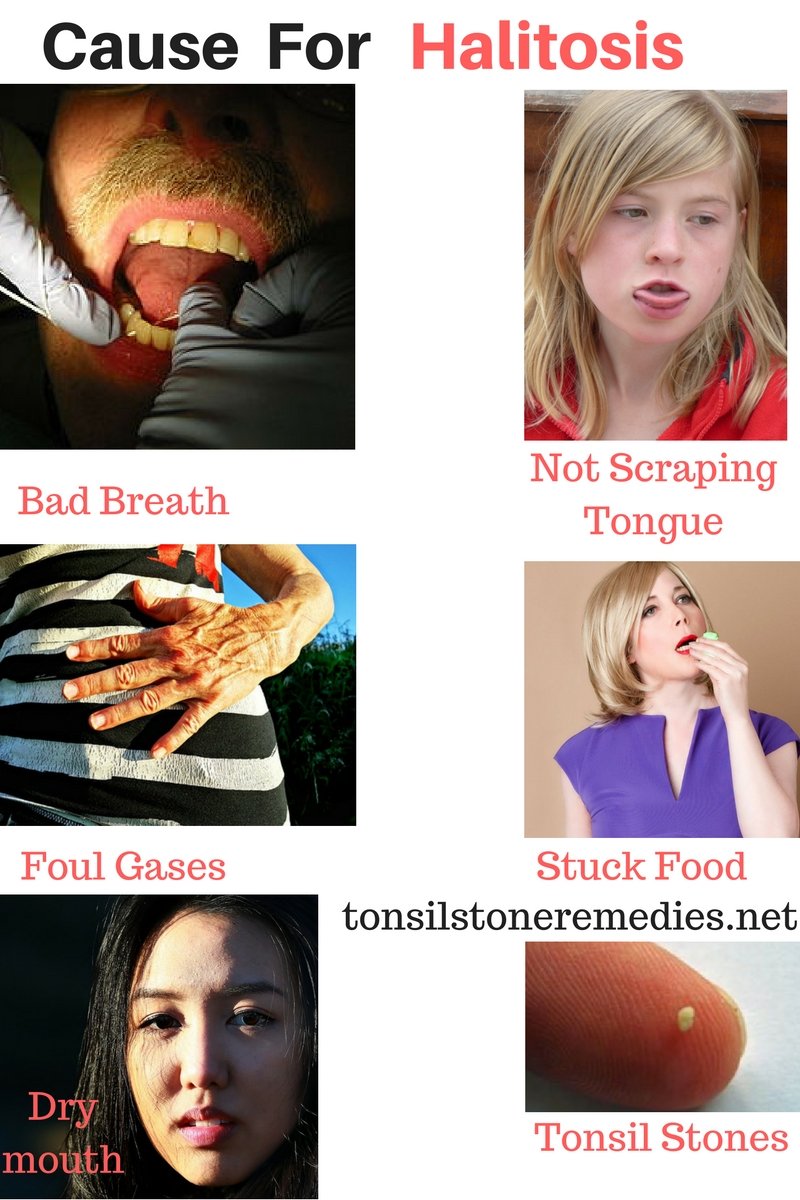 Do You Know The True Hidden Reasons Of Bad Breath do-you-know-the-true-hidden-reasons-of-bad-breath